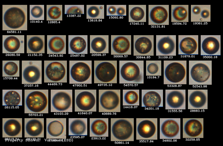 Snowflake Cataract